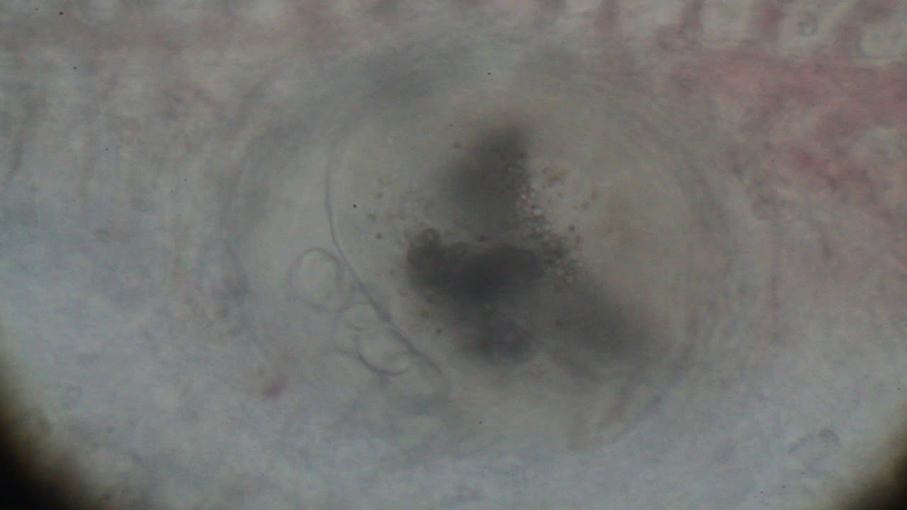 Cyst of Centrocestus (parasitic flatworm) in filament of fish gill ...