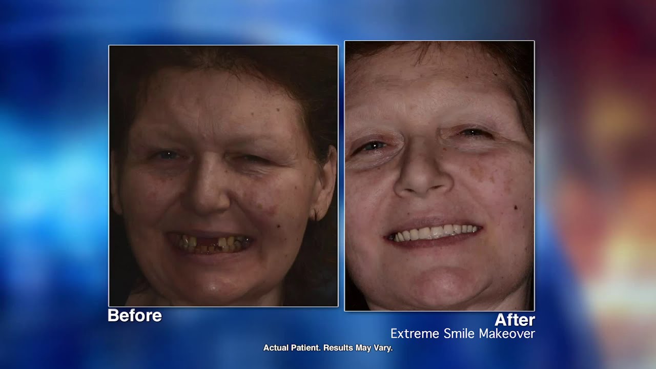 Extreme Smile Makeovers with Beverly Hills Dentist Dr. Parsa Zadeh ...