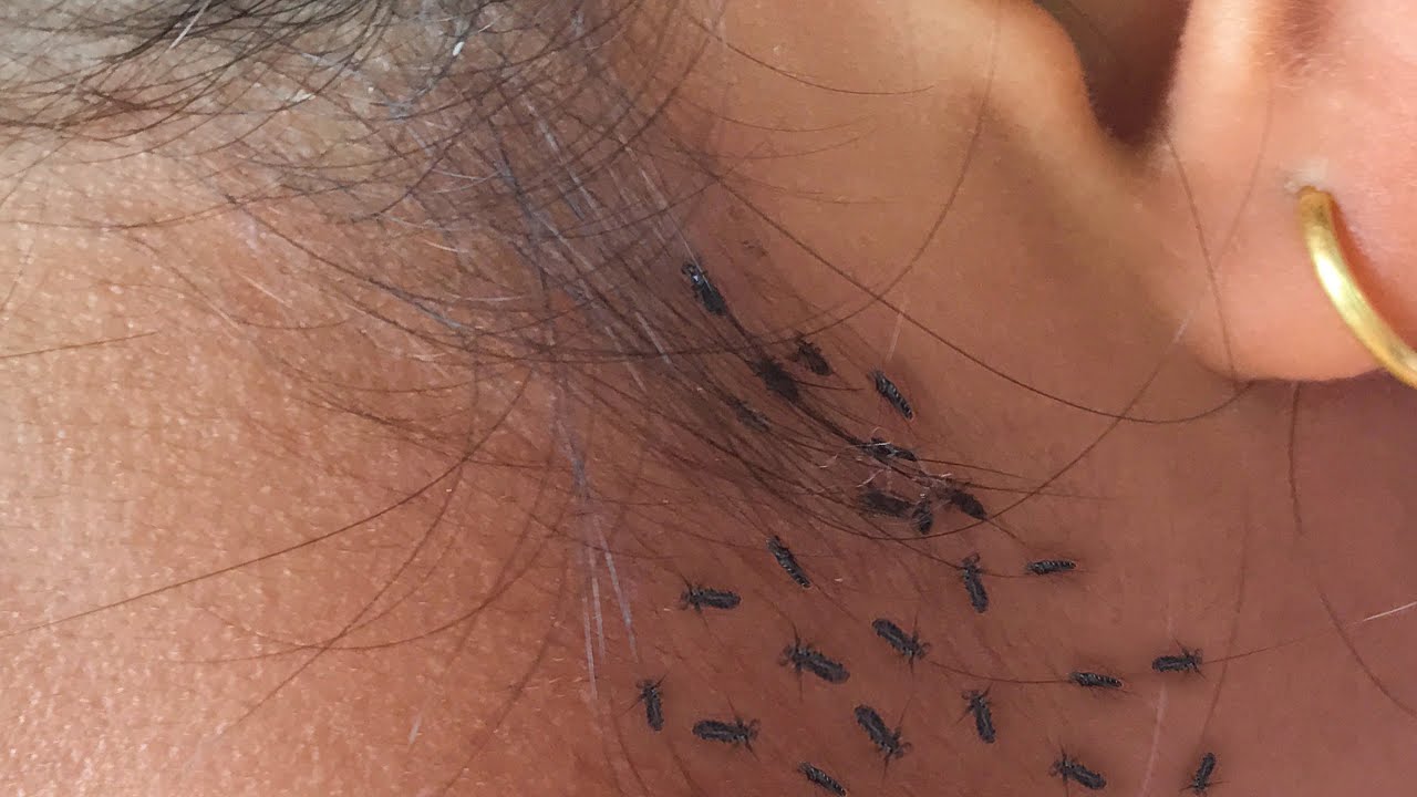 Nits picking Lice Picking Using Comb Lice Picking Long Hair ##38 - YouTube