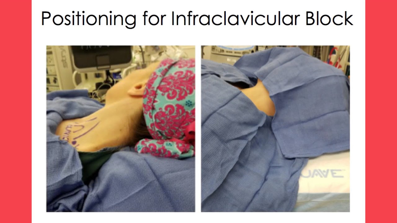 Infraclavicular Block - YouTube