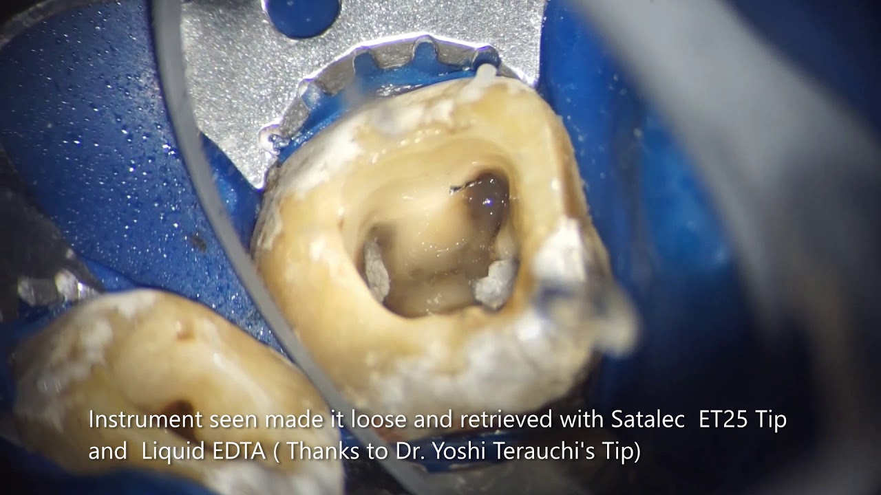 Management of Broken instrument under microscope - YouTube