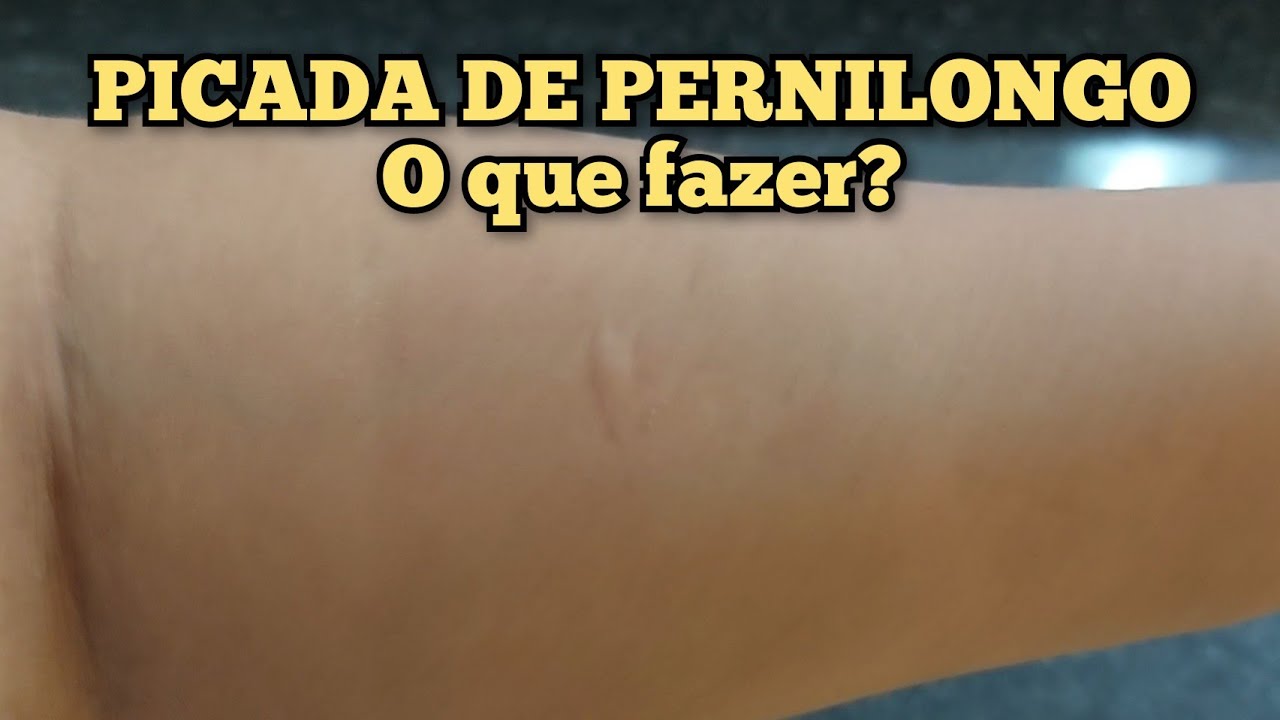 Picada De Mosquito Pernilongo e Muriçoca não Para de coçar, você não ...