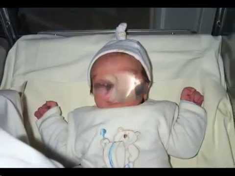 SINDROME MARSHALL SMITH - YouTube