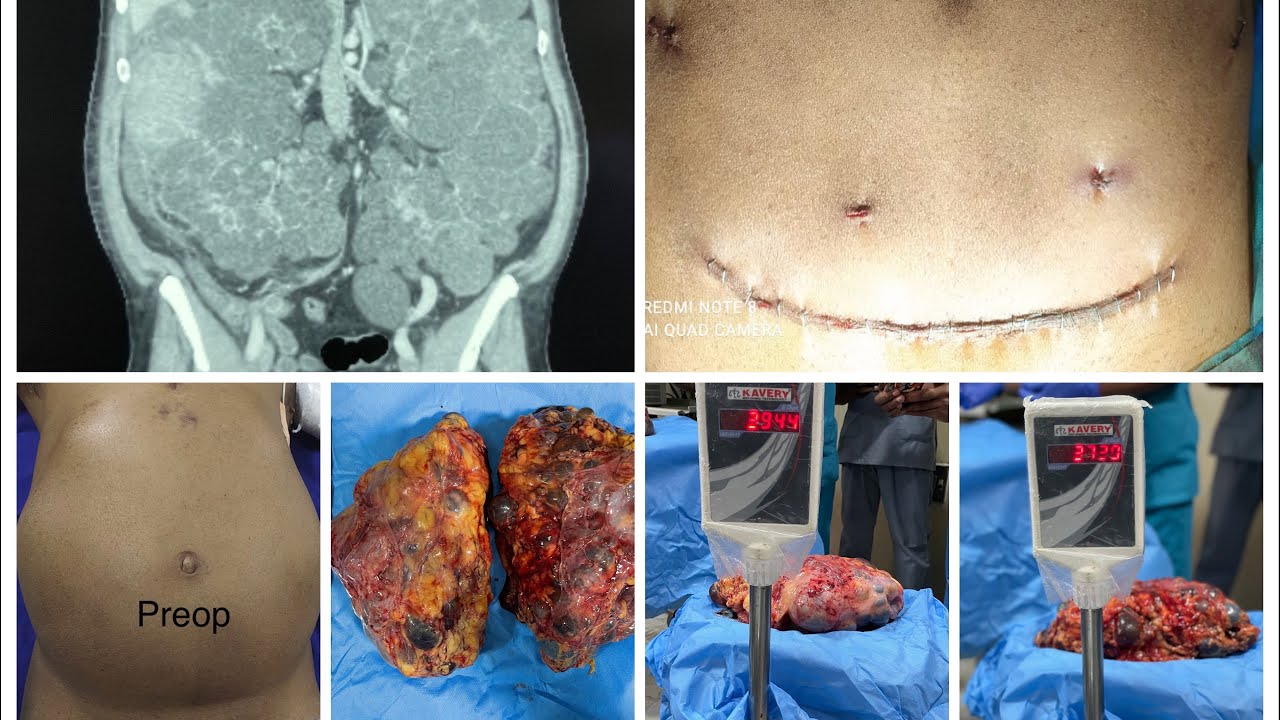 Laparoscopic Bilateral Nephrectomy for Polycystic Kidney ADPKD - YouTube