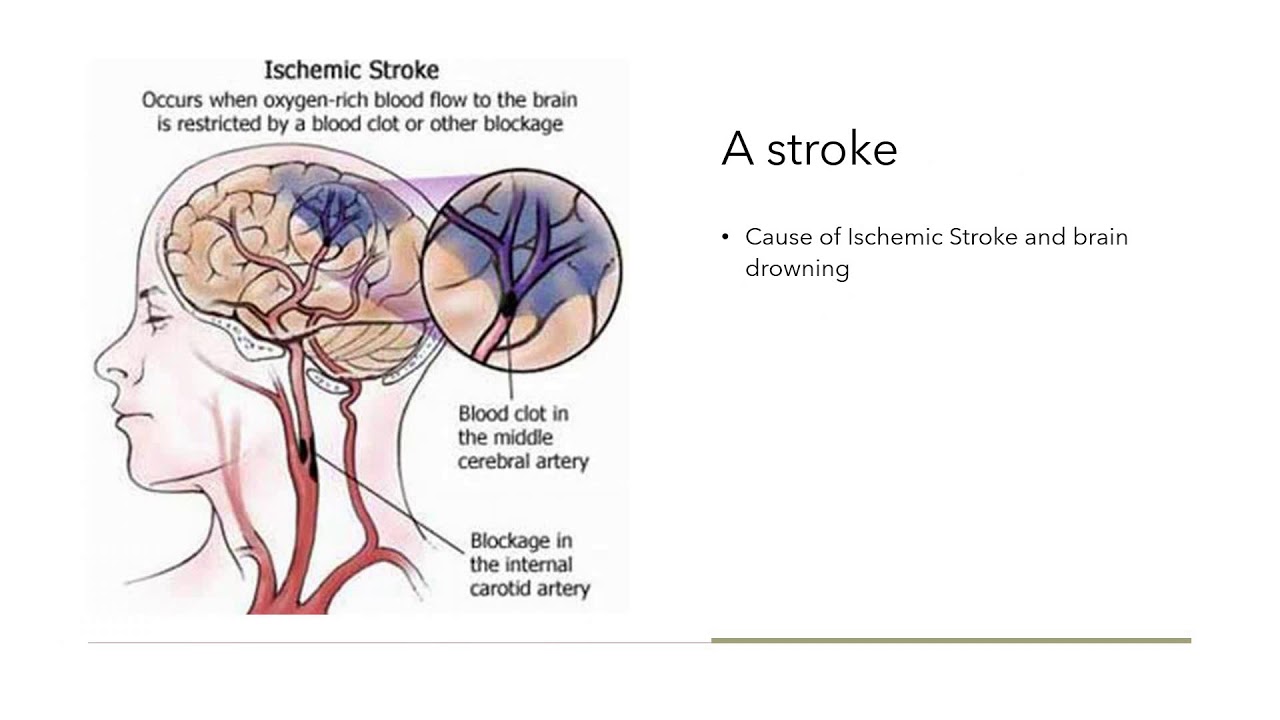 Brain drowns in its own fluid after a stroke - YouTube