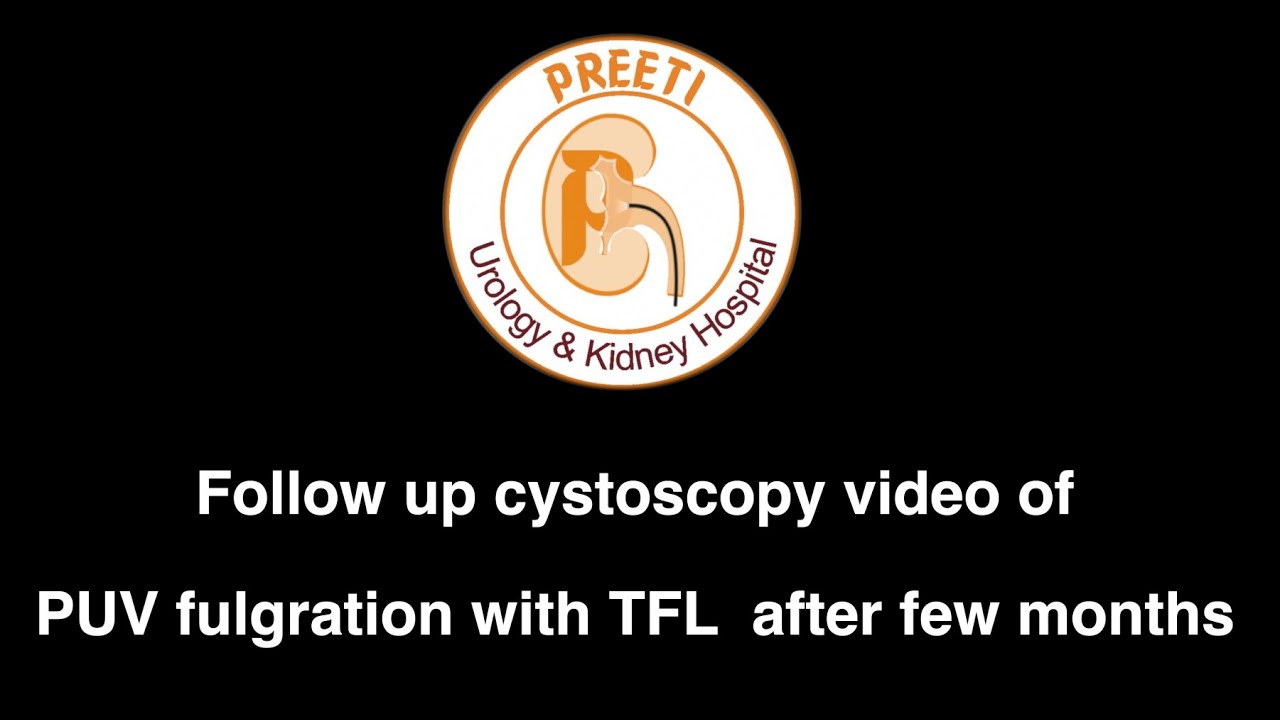 Follow up cystoscopy video of PUV fulgration with TFL after few months ...