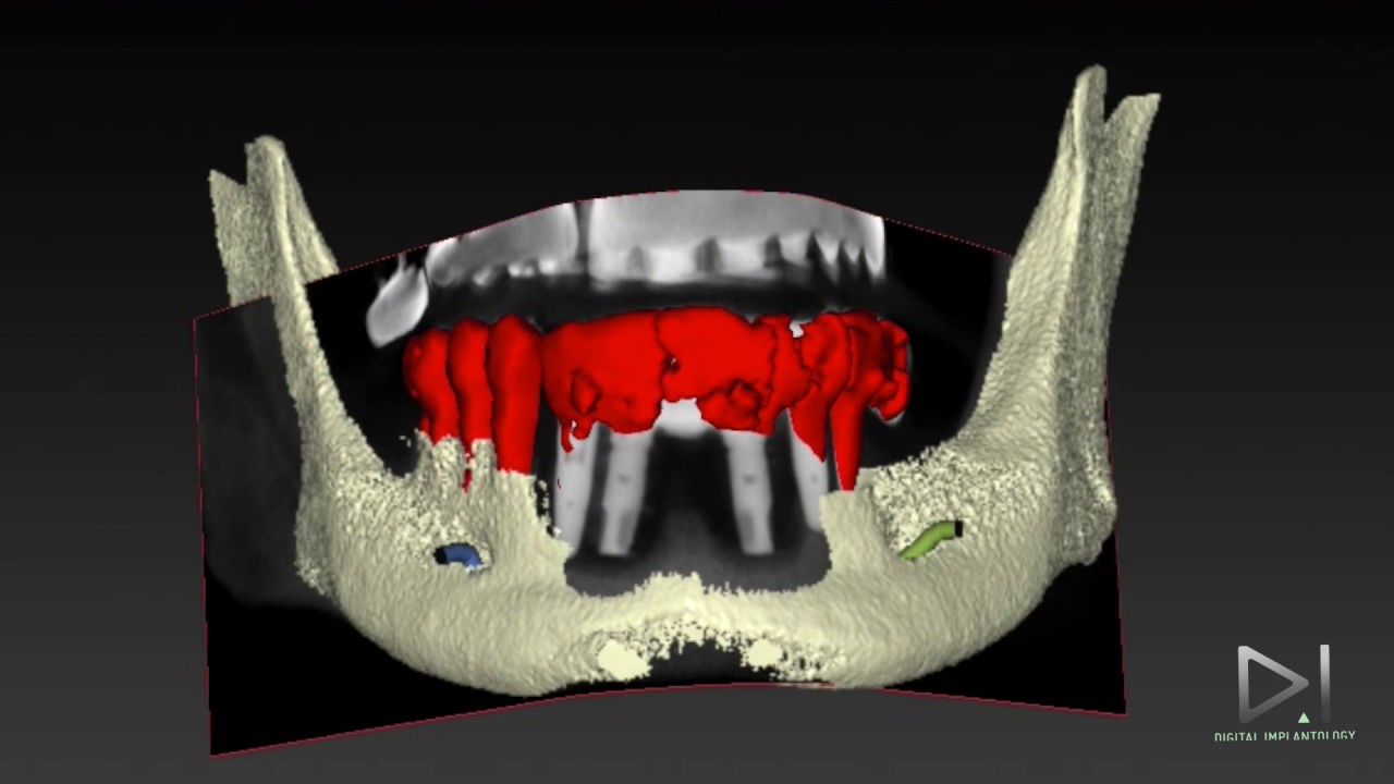 Full Dental implant surgery procedure immediate extraction - YouTube