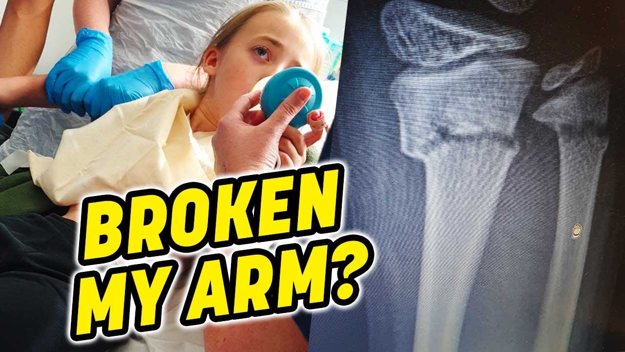 7 YEAR OLD BREAKS ARM IN CLIMBING FALL! - YouTube
