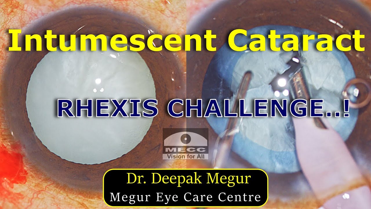 Intumescent Cataract - Rhexis Challenges,2 staged rhexis, Pearls for ...