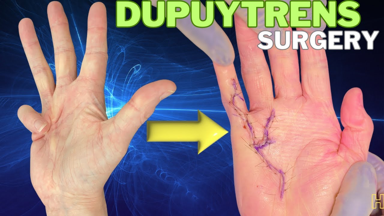 Dupuytren viking's hand correction surgery before and after - YouTube