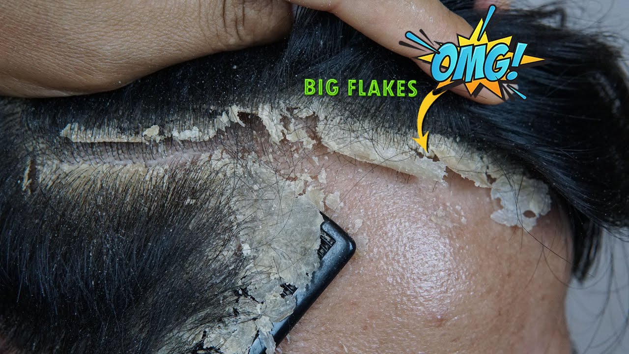 Big Flakes Scalp Scratching And Picking #1093 - YouTube