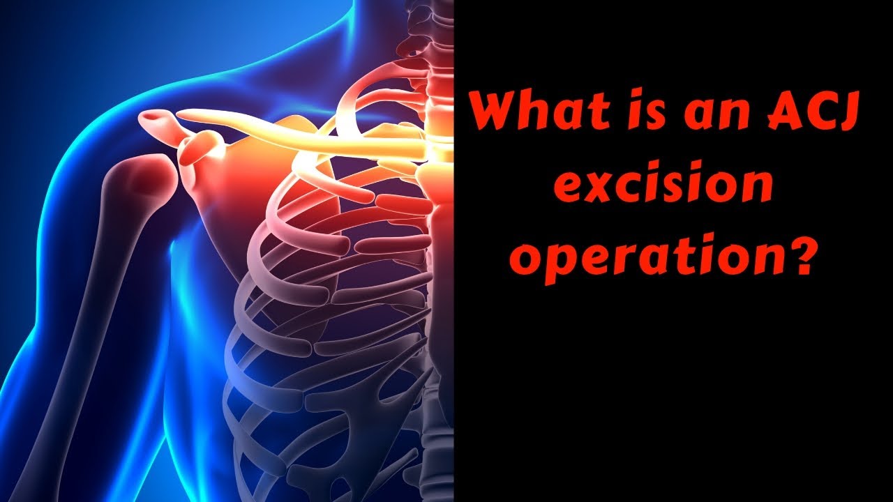 What is an ACJ joint excision operation? - YouTube