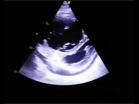 Echo case study Series @SafaMedicalLecture - YouTube