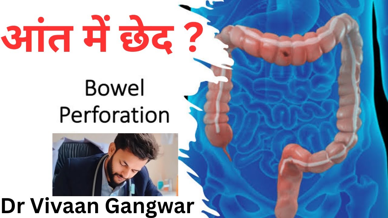 Bowel Perforation | Intestinal Perforations | Bowel Perforation Causes ...