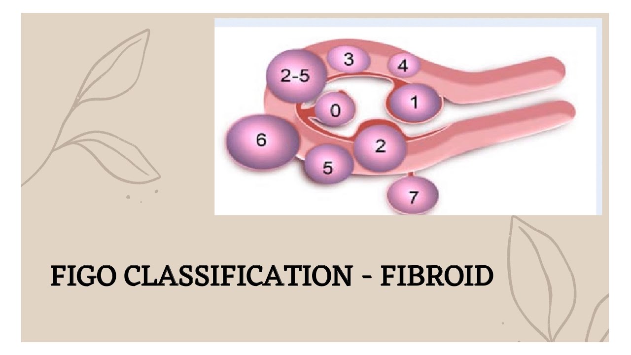 FIGO classification of FIBROIDS #educationalvideo #radiology #neet2024 ...
