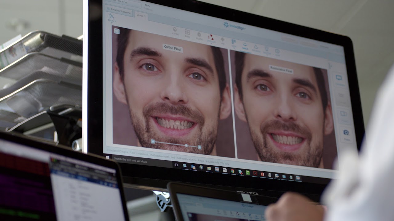 Align Tech Corp Video 2017 - YouTube