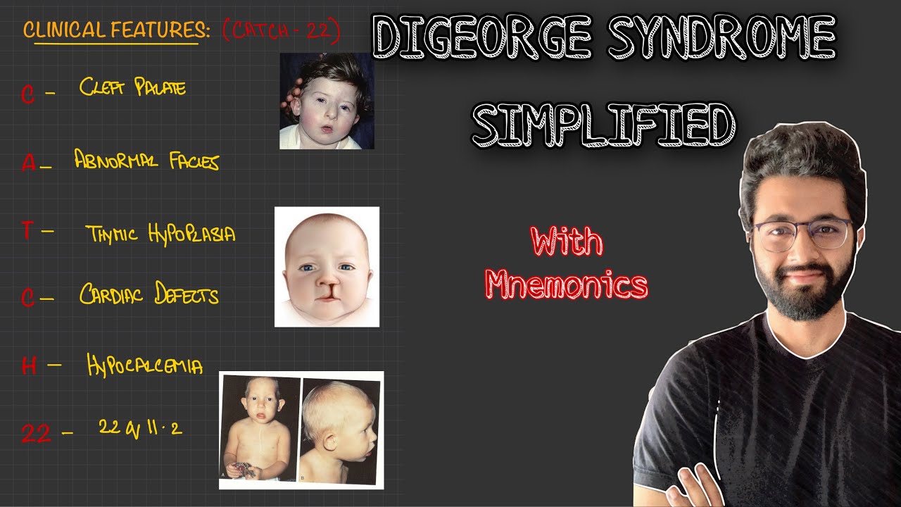 Digeorge Syndrome - Etiopathogenesis, Clinical Features,Diagnosis and ...