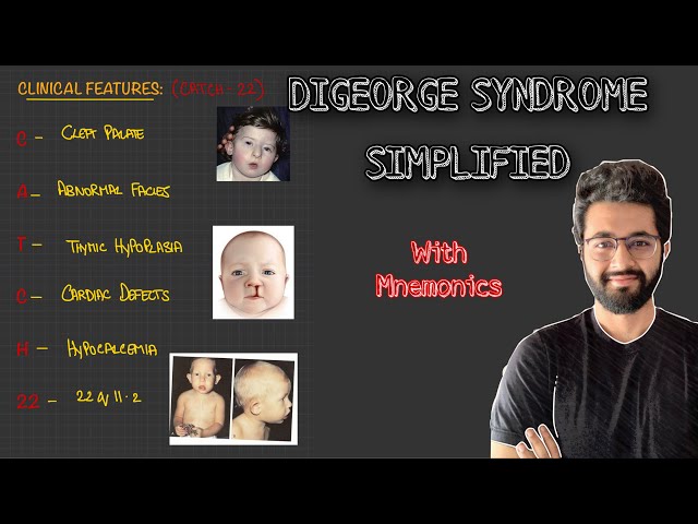 Sindrome De Digeorge DiGeorge Syndrome: Pathogenesis And Clinical