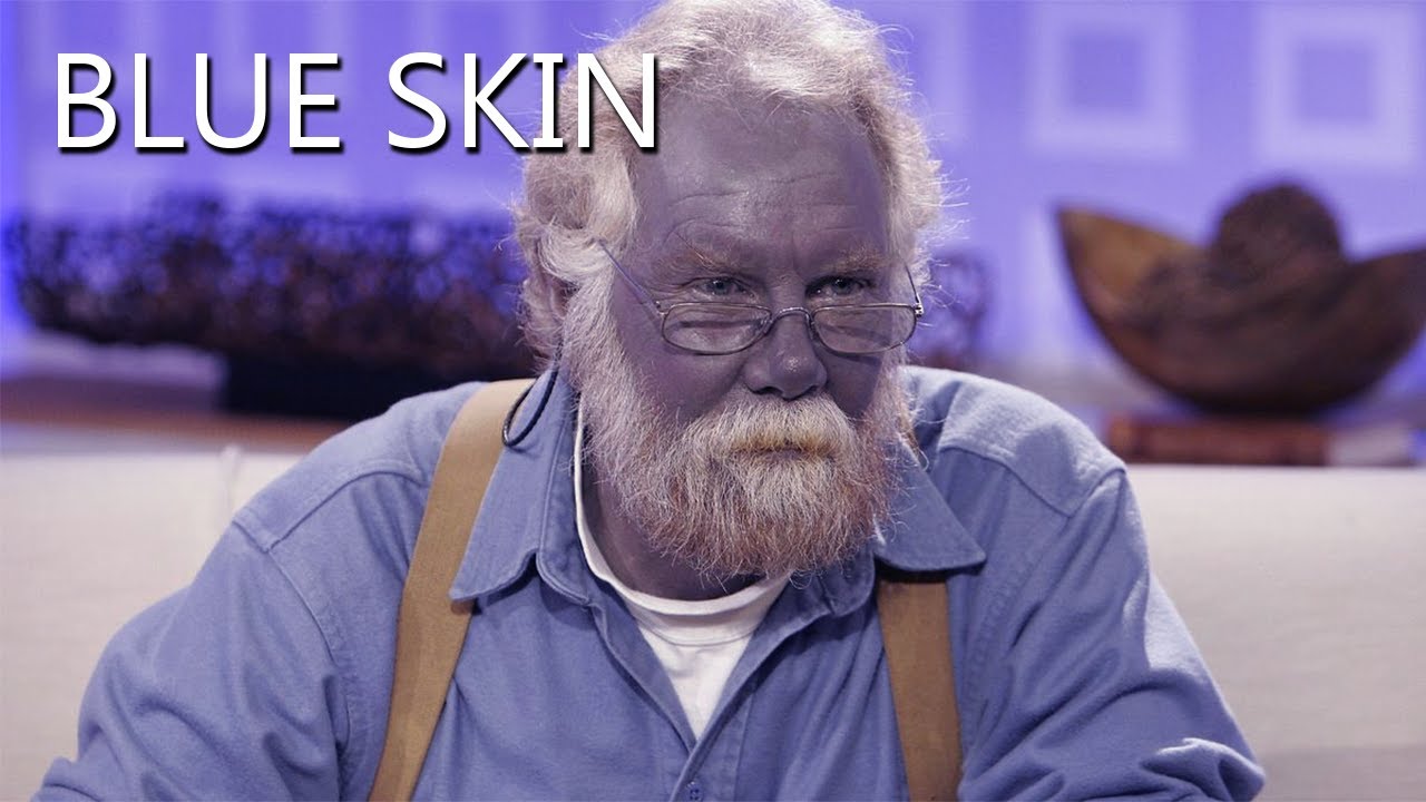 ARGYRIA: The rare disease that turns people blue - YouTube