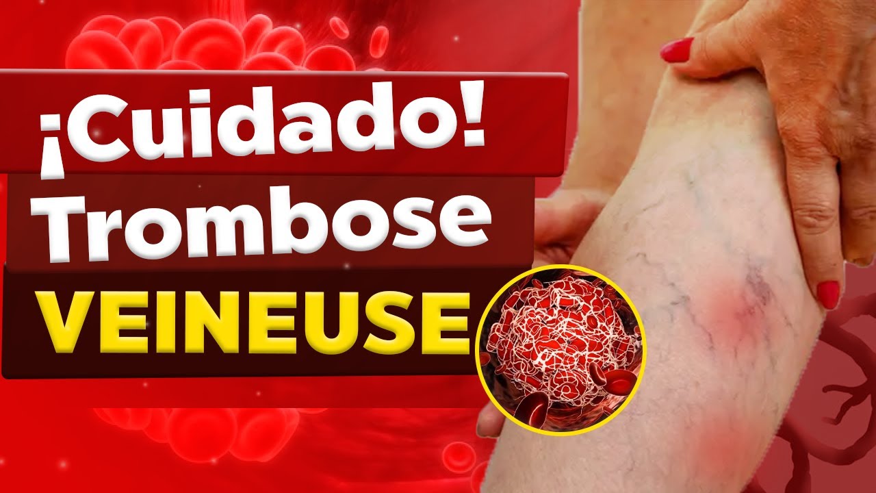 LA THROMBOSE VEINEUSE. Signes d'ALARME. - YouTube