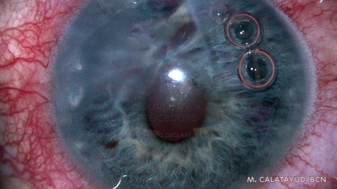 Combined cataract surgery, humanoptics iris implant and DSAEK - YouTube