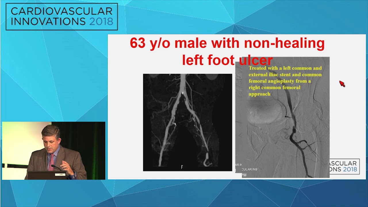 CVI2018 Session: When to use US, CTA or MRA before going to the cath ...