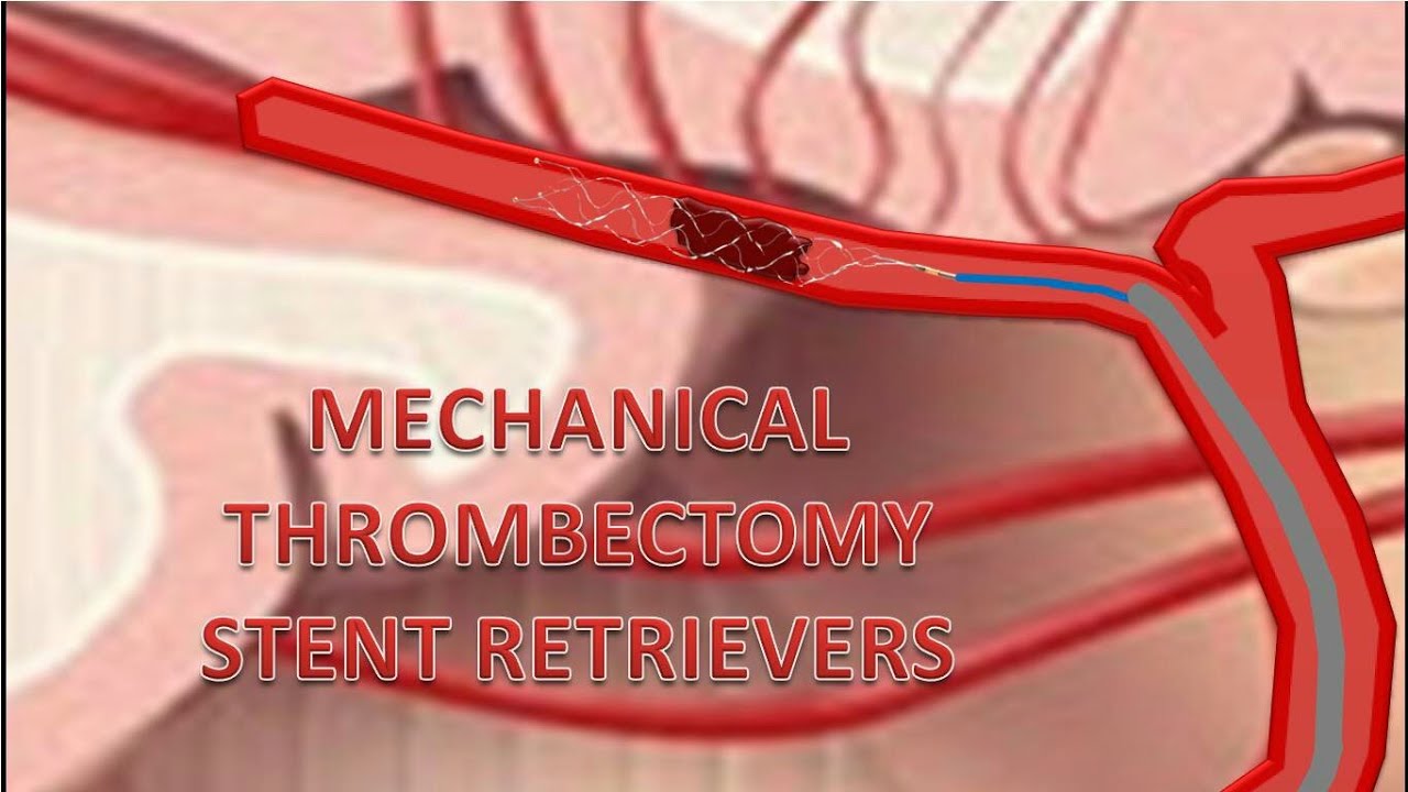 Video 40 Mechanical Thrombectomy Stent Retrievers - YouTube