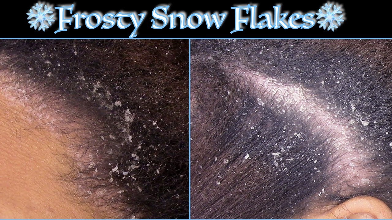 Scratching, Brushing, & Picking Snow Flakes pt.1 #dandruffremoval # ...