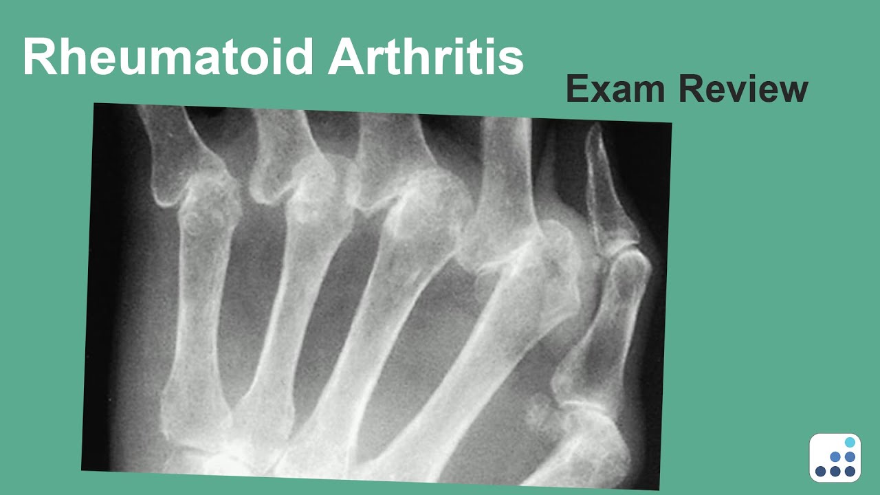 Rheumatoid Arthritis Exam Review - Matthew L. Ramsey, MD - YouTube