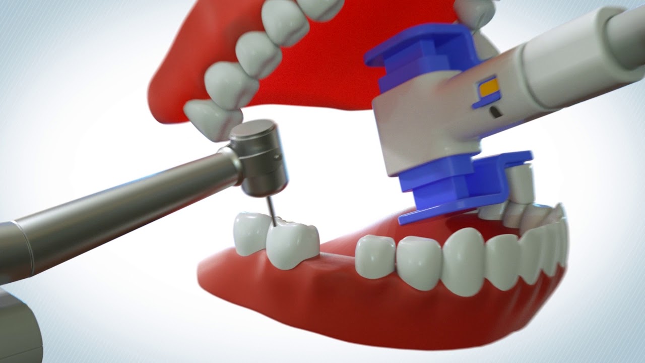 3D Dental Prep Robot jungwonindustech - YouTube