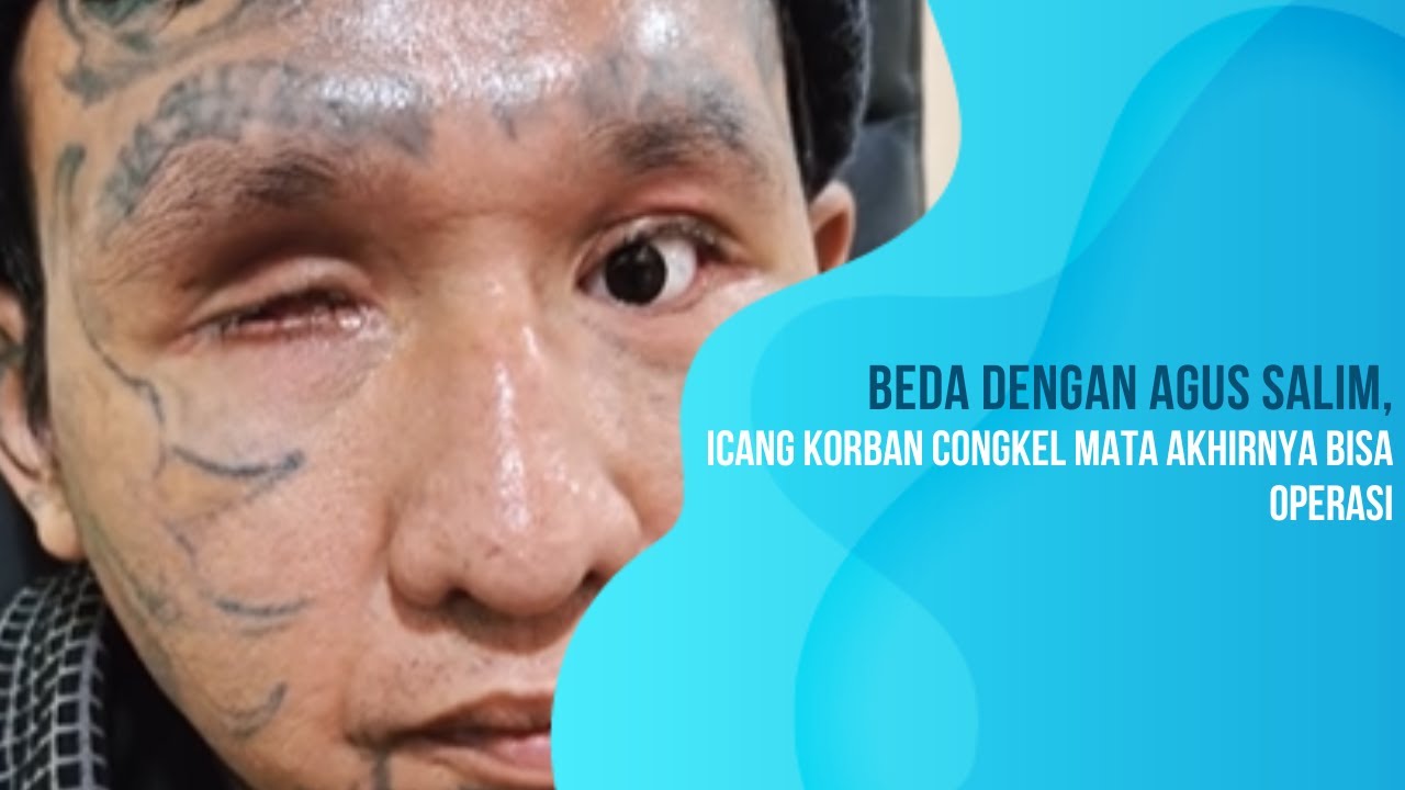 Beda Dengan Agus Salim, icang Korban Congkel Mata Akhirnya Bisa Operasi ...