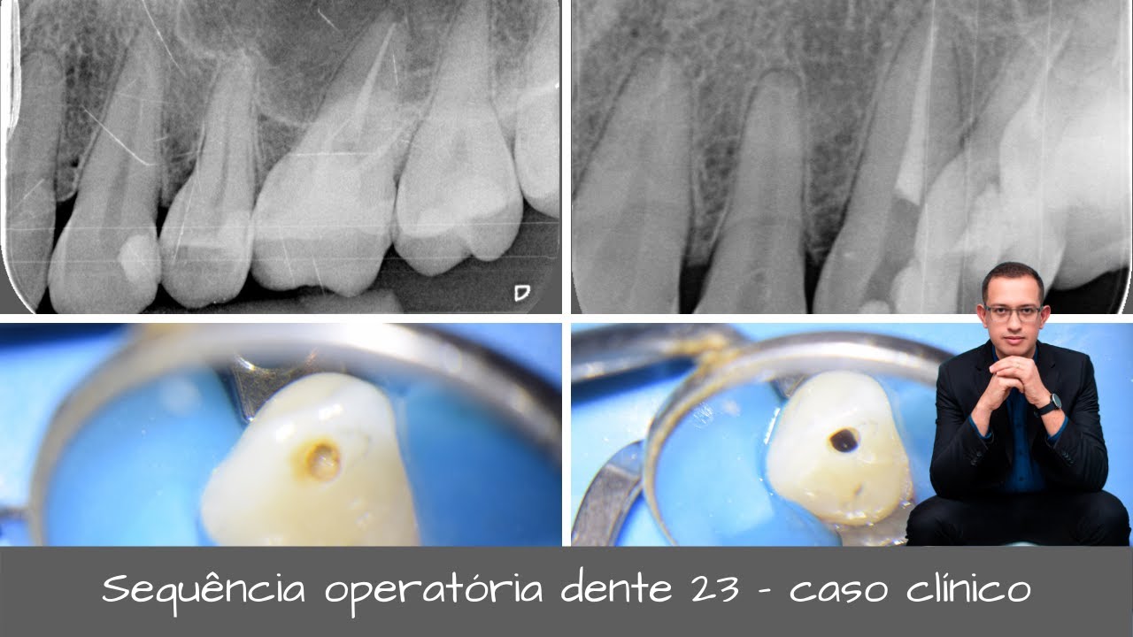 Tratamento de canal | Endodontia Avançada | Dente 23 | Microscopia ...