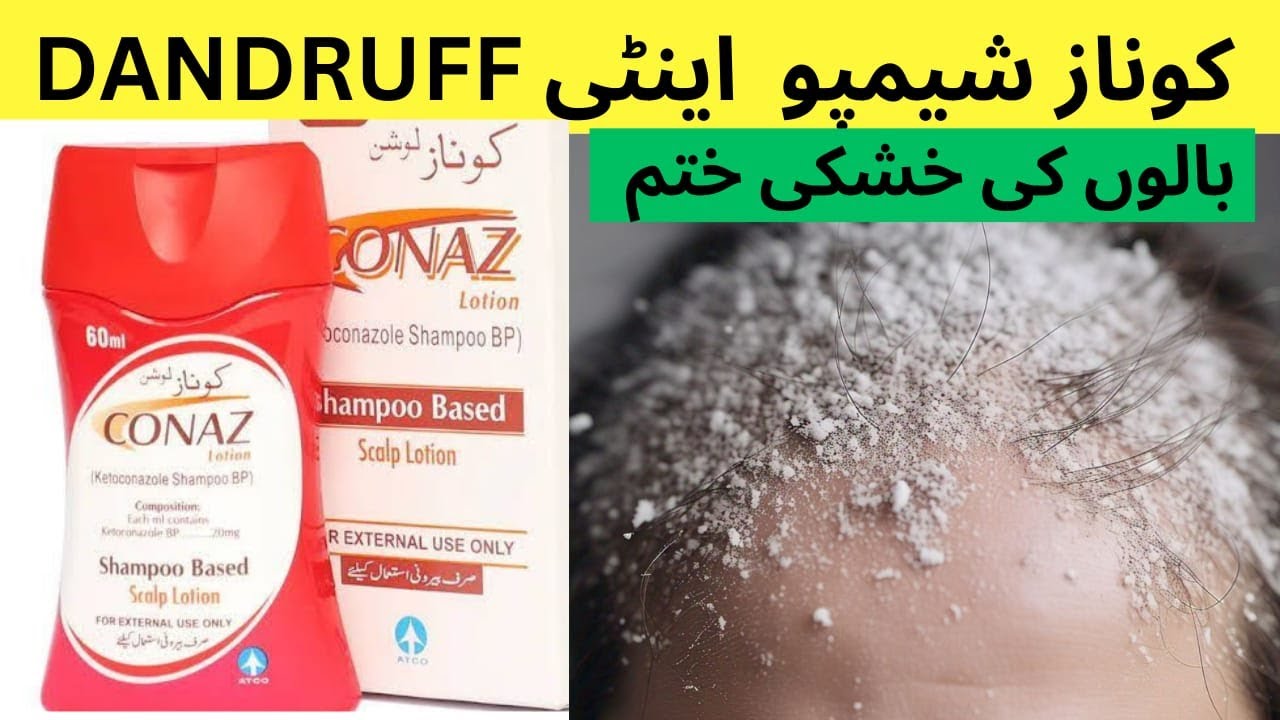 Conaz Shampoo ke fayde | Conaz Shampoo How to Use | Best Anti Dandruff ...