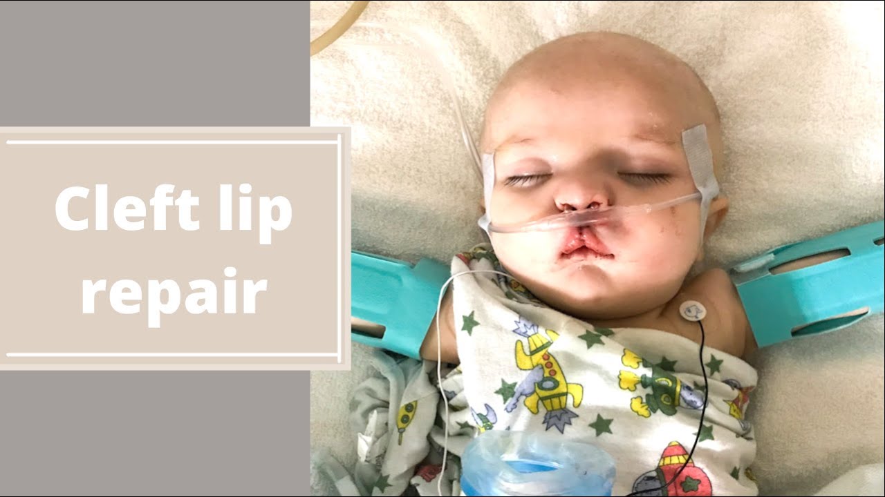CLEFT LIP REPAIR- Basic surgery and recovery information - YouTube