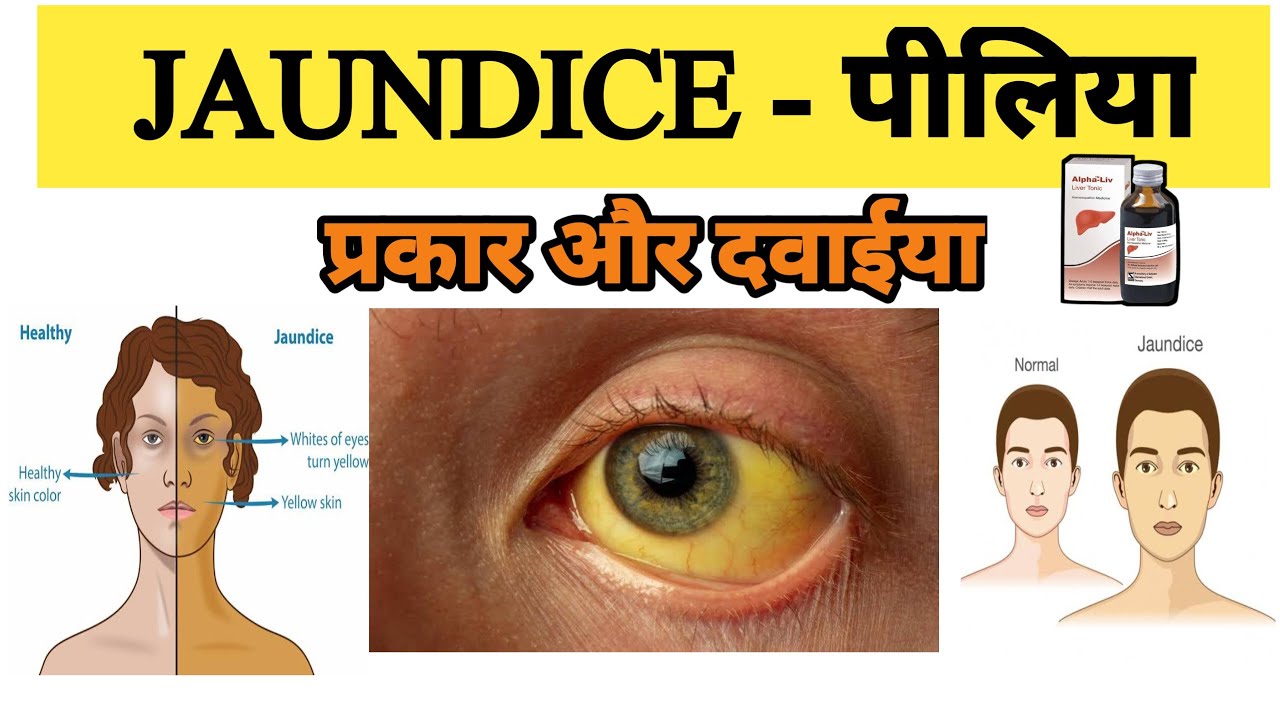 Jaundice treatment || Types of Jaundice || Symptoms of Jaundice || What ...