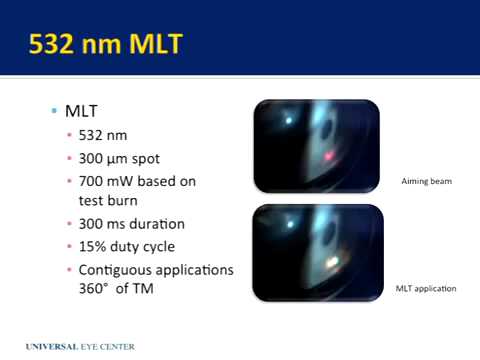 532 nm MicroPulse Laser Trabeculoplasty (MLT) - YouTube