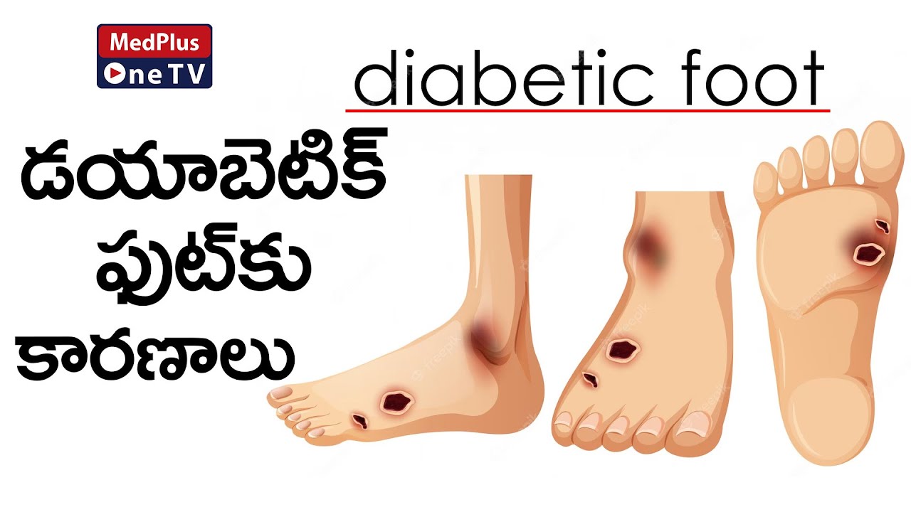 Diabetic Foot Causes,Symptoms and Treatment | Dr.B Ananta Rao ...