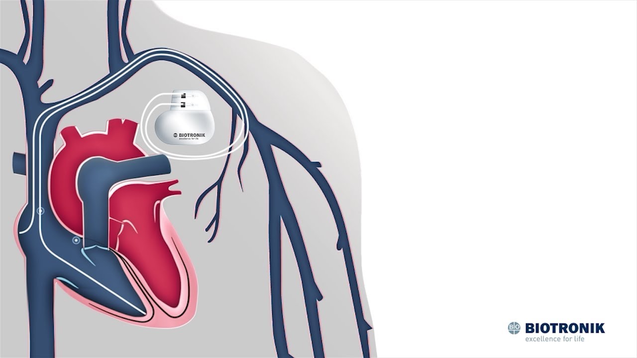 Cómo funcionan los marcapasos | Animación médica - YouTube