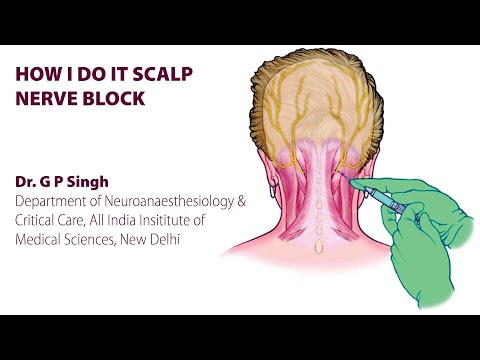 HOW I DO IT SCALP NERVE BLOCK - YouTube
