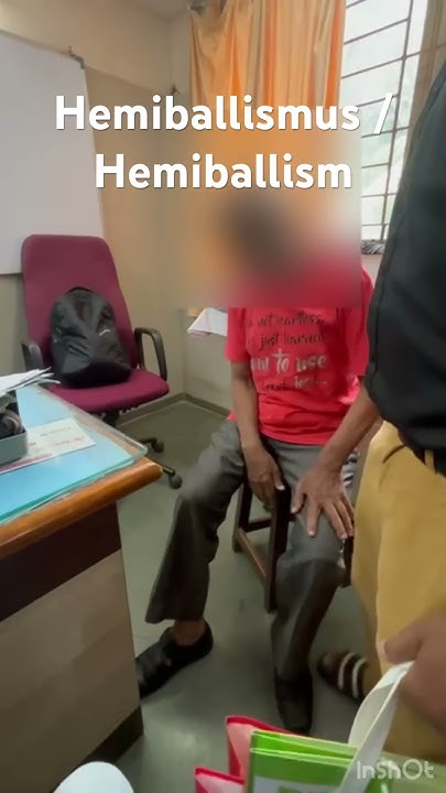 Hemiballismus Hemiballism Subthalamic Nucleus Neurology