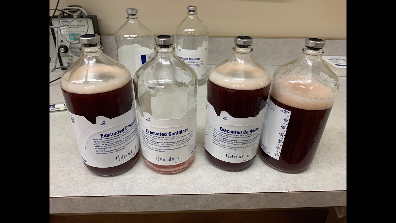 Paracentesis Procedure - THE PROCEDURE! Part III in a series - YouTube