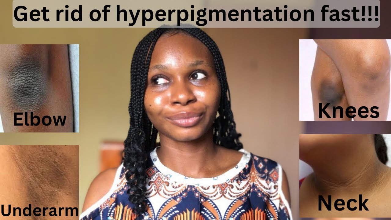 How to Get Rid of Hyperpigmentation | Dark Spots | Uneven Skin Tone ...