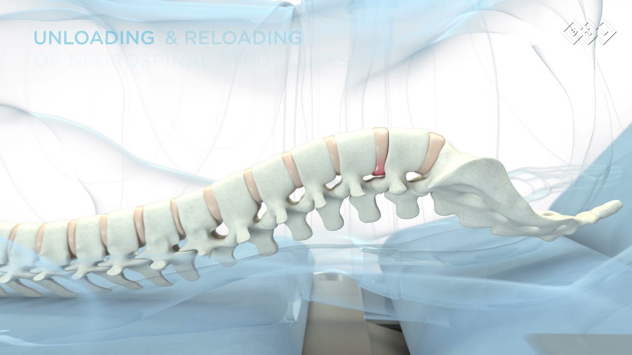 BTL Spinal Decompression - Mechanism of action - YouTube