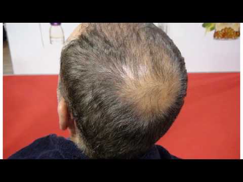Fix Cosmetic Fixplant Toppik ''Before - After'' Uygulamaları