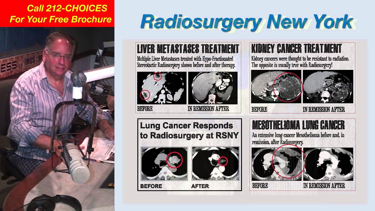 Dr. Gil Lederman's Radiosurgery Show! Podcast 127 Part TWO - YouTube