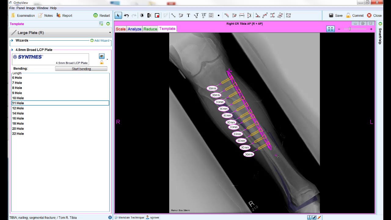 Planning a Fracture Management Procedure | Materialise OrthoView - YouTube