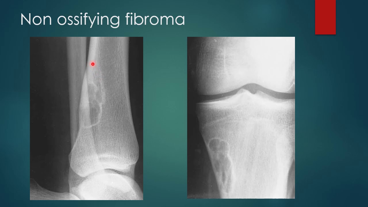 Non ossifying fibroma xray || Fibrous cortical defect xray || Radiology ...