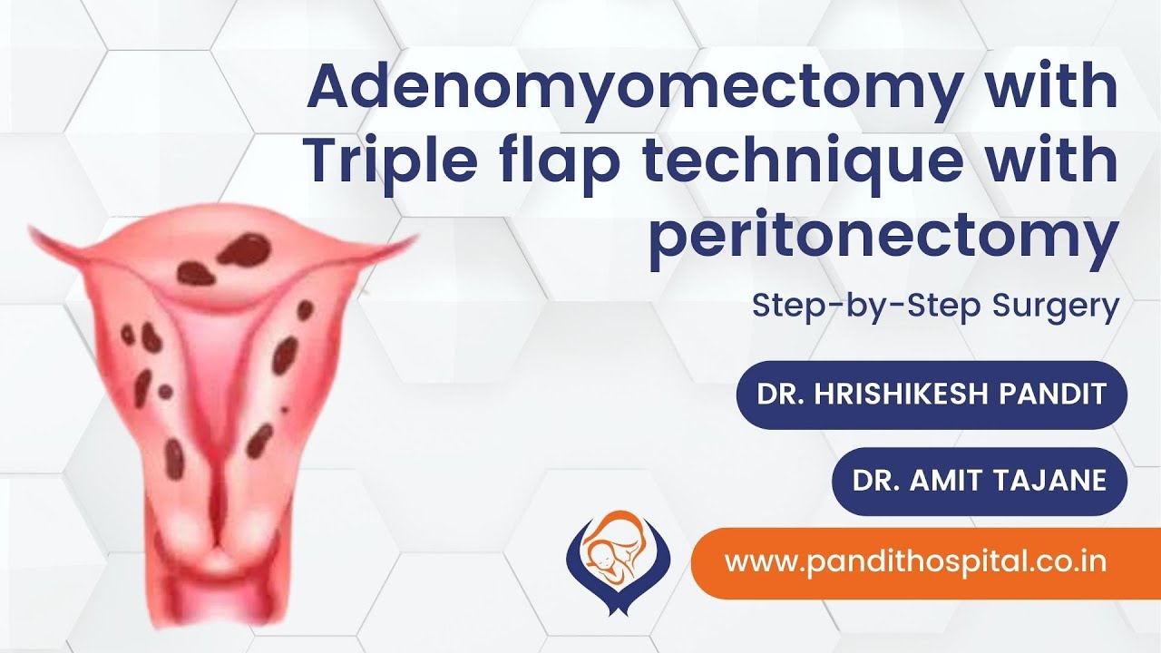 Laparoscopic Adenomyomectomy with Triple Flap Technique with Peritonectomy (Stepwise Surgery ...