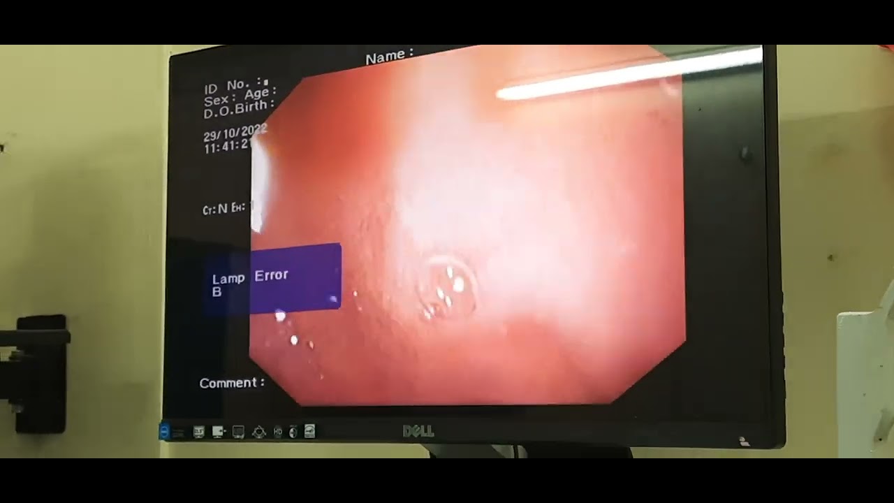 Endoscopy On A Patient With Chronic Gastritis Youtube