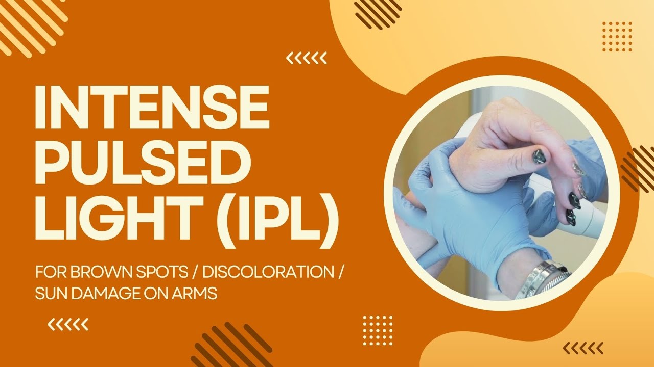 Intense Pulsed Light (IPL) for Brown Spots/Discoloration/Sun Damage on ...